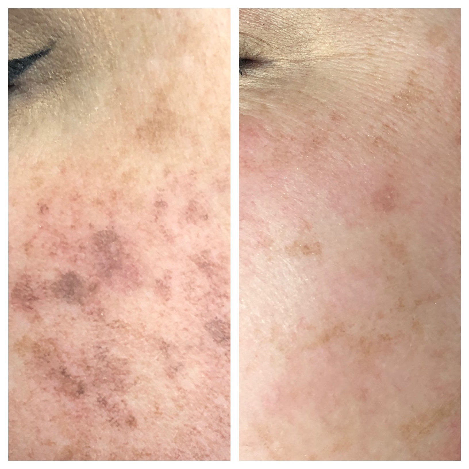 Skin Resurfacing for Younger-Looking Skin in Bourbonnais, IL